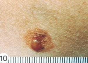 Nei pericolosi: come riconoscerli - Idee Green